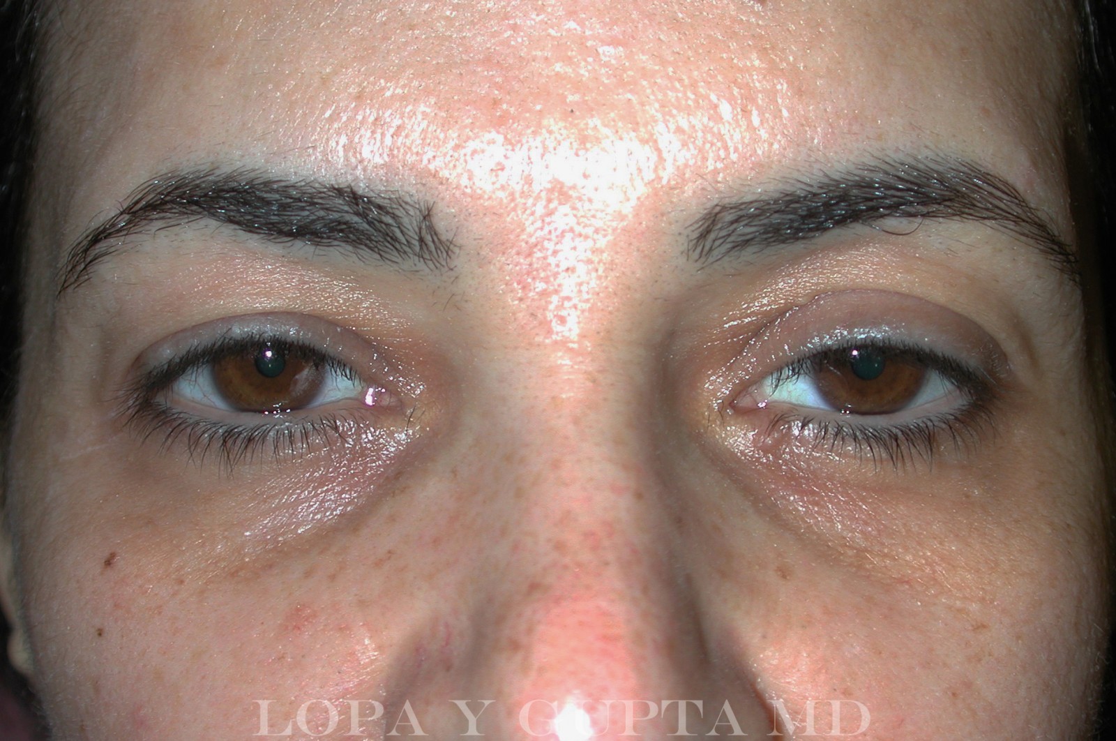 Ptosis Repair | Lopa Yogesh Gupta M.D., FAAO, FAACS
